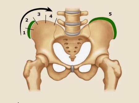 The Risser sign, growth and scoliosis: let’s clear a few things up - ISICO